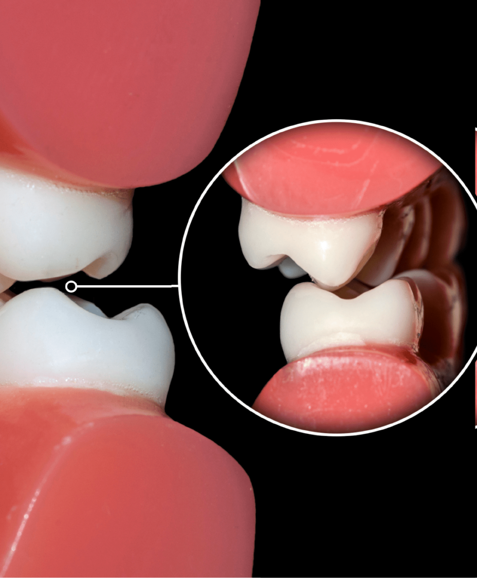 Bite Therapy | Mississippi Periodontic Specialists Group